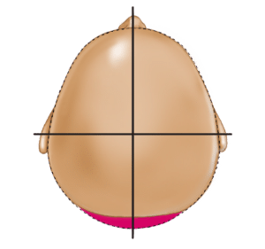 Assessment of Baby Head Shapes | Plagiocephaly & Brachycephaly | Starband