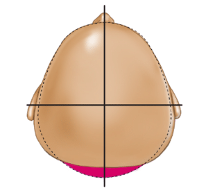 Assessment of Baby Head Shapes | Plagiocephaly & Brachycephaly | Starband