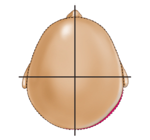 Assessment of Baby Head Shapes | Plagiocephaly & Brachycephaly | Starband