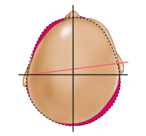 Assessment of Baby Head Shapes | Plagiocephaly & Brachycephaly | Starband