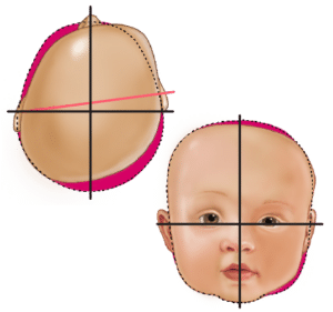 Assessment of Baby Head Shapes | Plagiocephaly & Brachycephaly | Starband