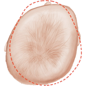 Assessment of Baby Head Shapes | Plagiocephaly & Brachycephaly | Starband